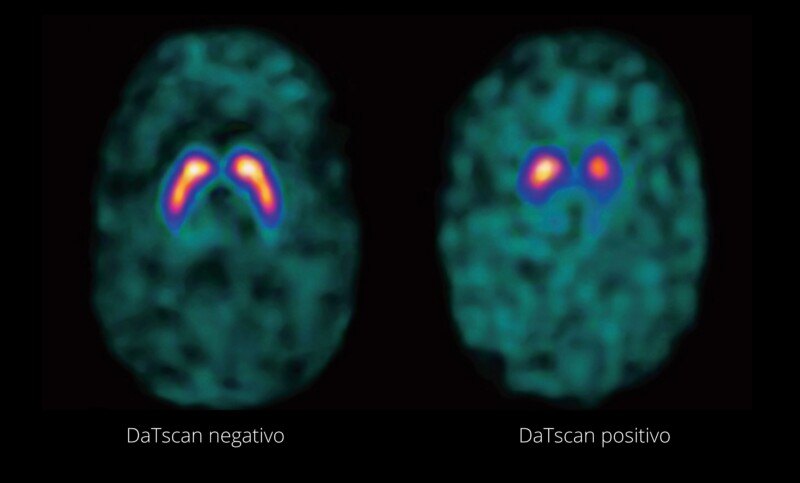 Datscan Parkinson - Guarnieri